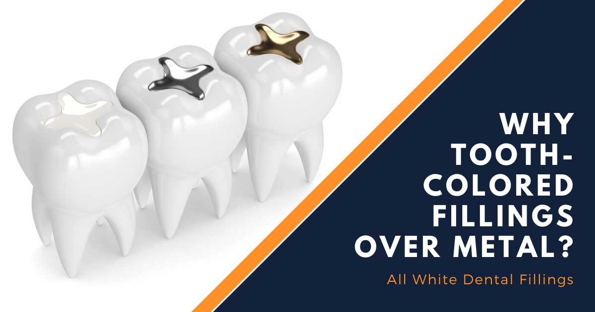 Why Tooth-Colored Dental Fillings Over Metal Fillings - Oklahoma City, OK